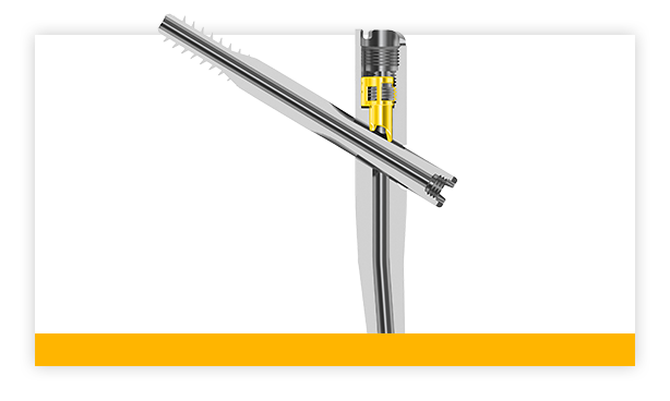 First European surgeries completed using Stryker’s Gamma4 Hip Fracture ...