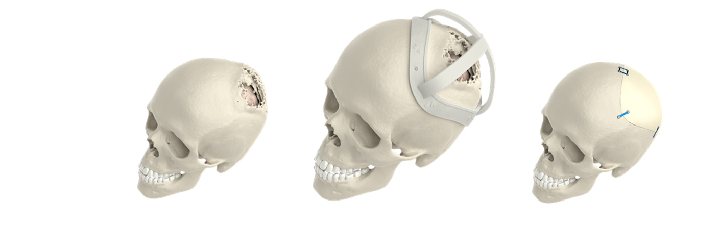 Cranial iD - PEEK Single Stage | Stryker