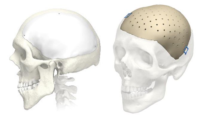 Cranial iD | Stryker