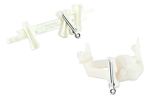 VSP Reconstruction | Stryker