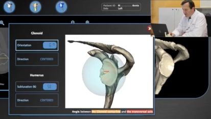 Blueprint® Tutorial using Tornier Perform® Anatomic Glenoid with Gilles ...