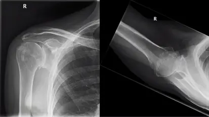 Bone Preserving TSA with Tornier Simpliciti® Shoulder System and ...