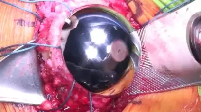 Tornier Simpliciti® Shoulder System Surgical Case – Armodios Hatzidakis ...