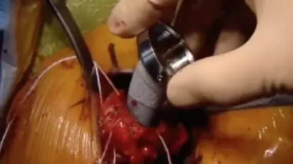 Shoulder arthroplasty featuring the Tornier Flex Shoulder System ...