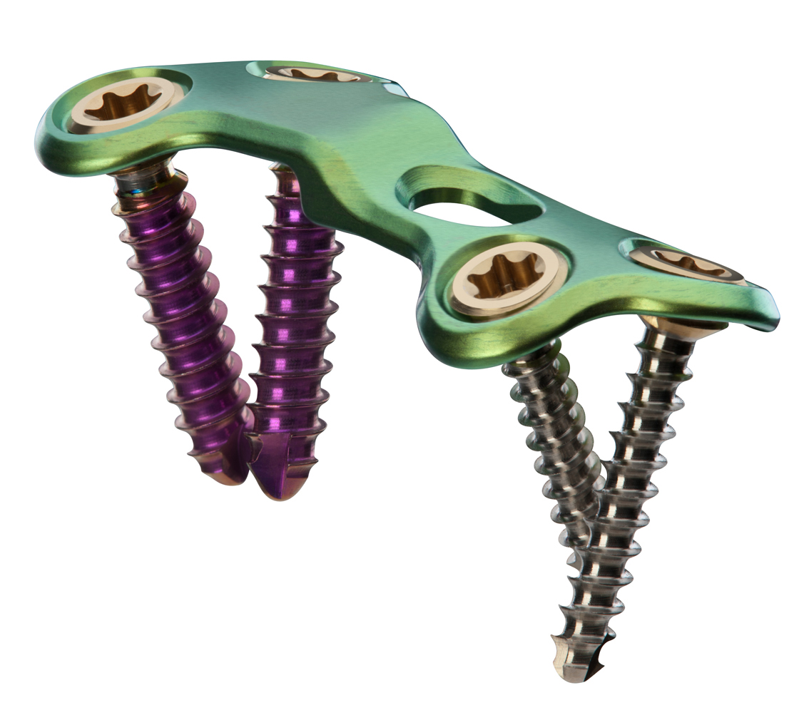 Ortholoc 3Di System | Stryker