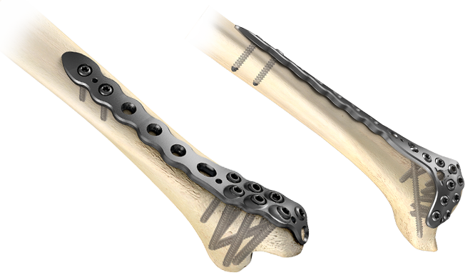 AxSOS 3 Ti Distal Tibia | Stryker