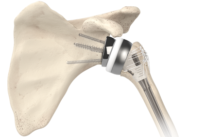 ReUnion RFX | Stryker