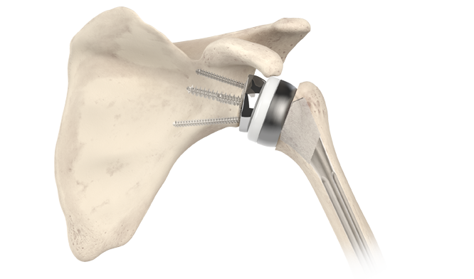 Mechanical Shoulder Prosthesis