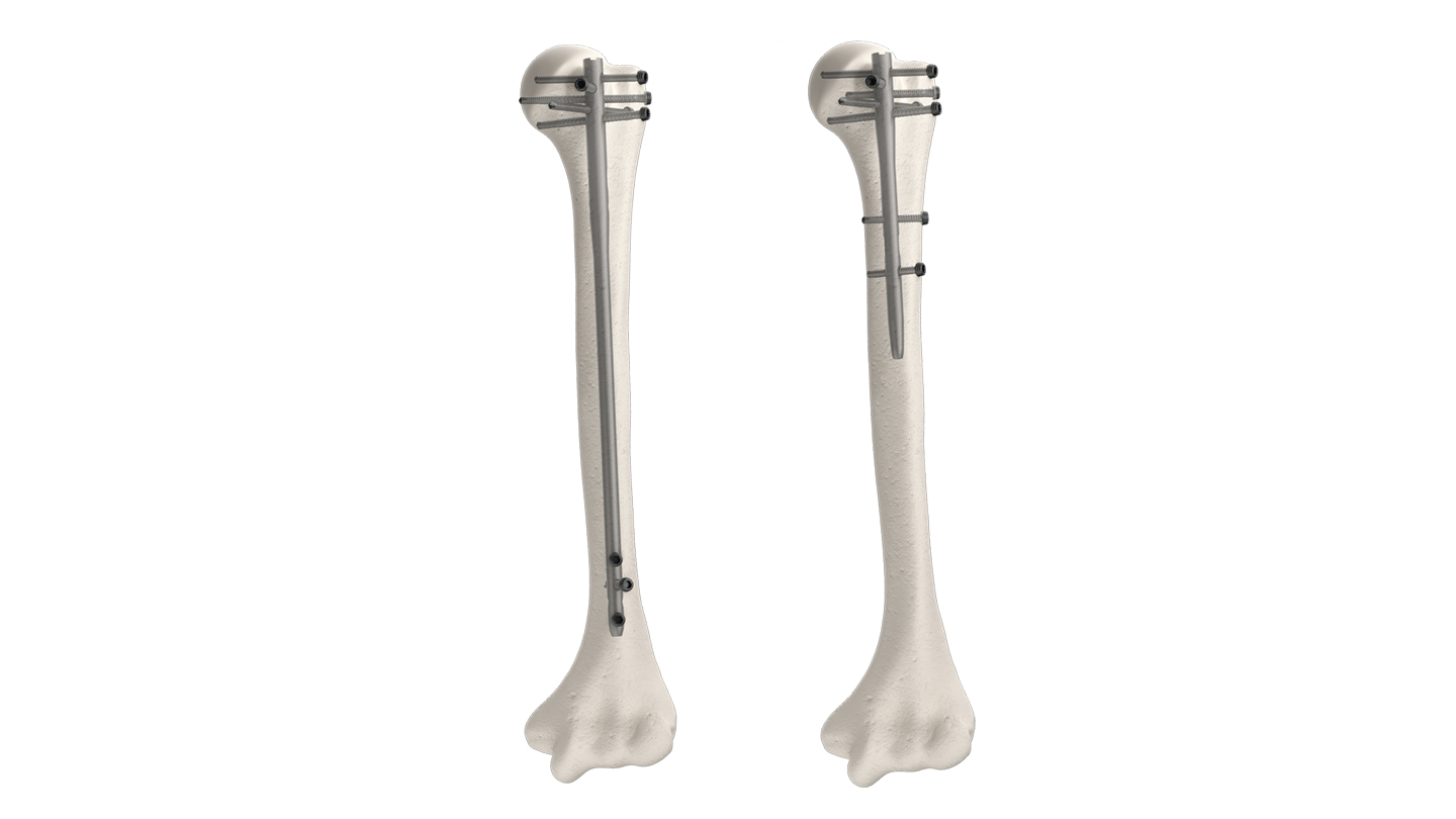 T2 Alpha Humeral Nail | Stryker