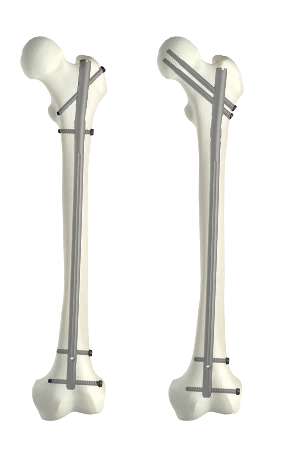 T2 Alpha Antegrade Femur | Stryker