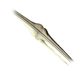 T2 Knee Arthrodesis | Stryker