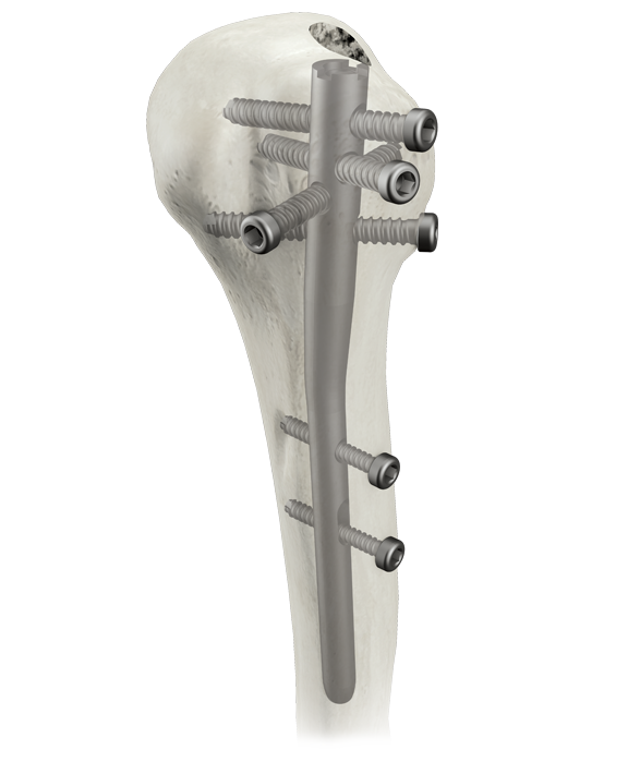 T2 Proximal Humeral | Stryker