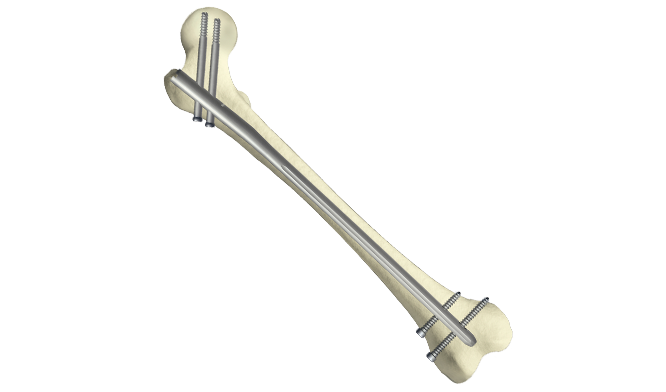 T2 Clou de reconstruction | Stryker