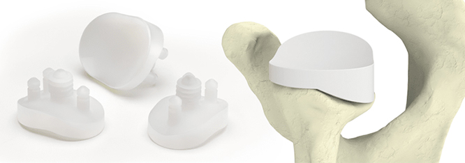 Tornier Perform Anatomic Glenoid and Anatomic Augmented Glenoid | Stryker