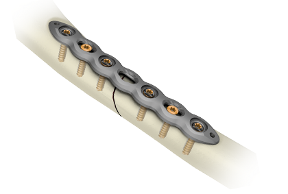 VariAx 2 Compression Plating System | Stryker