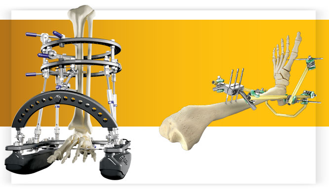 External Fixation Device Types - Infoupdate.org